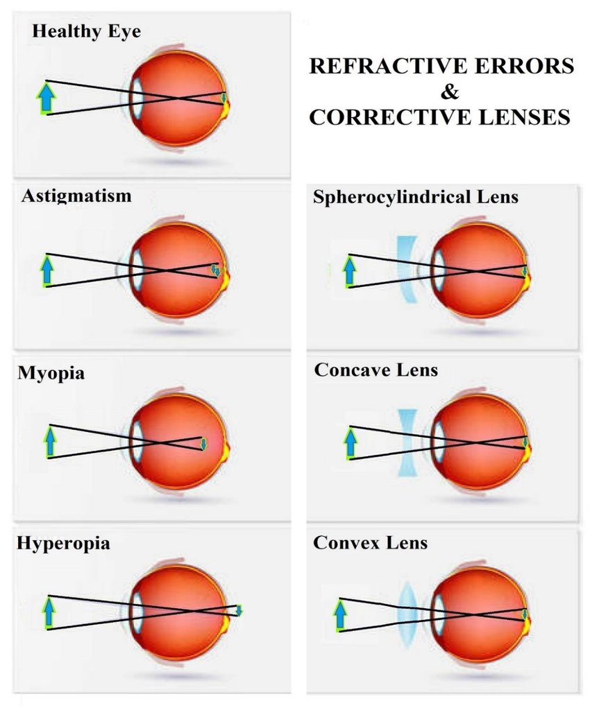 Refractive Errors Thind Eye Hospital Refractive Errors Thind Eye Hospital