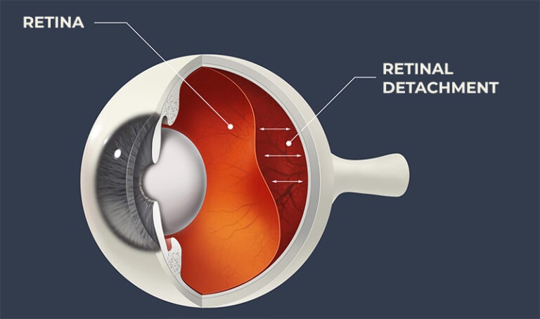 Retinal Detachment - Thind Eye Hospital